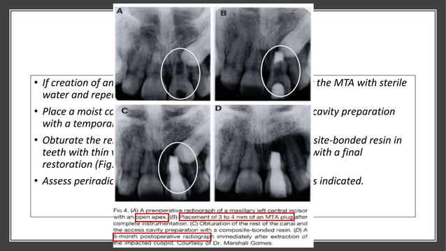 CLINICAL APPLICATIONS OF MTA | PPTX | Dental Health | Diseases and ...