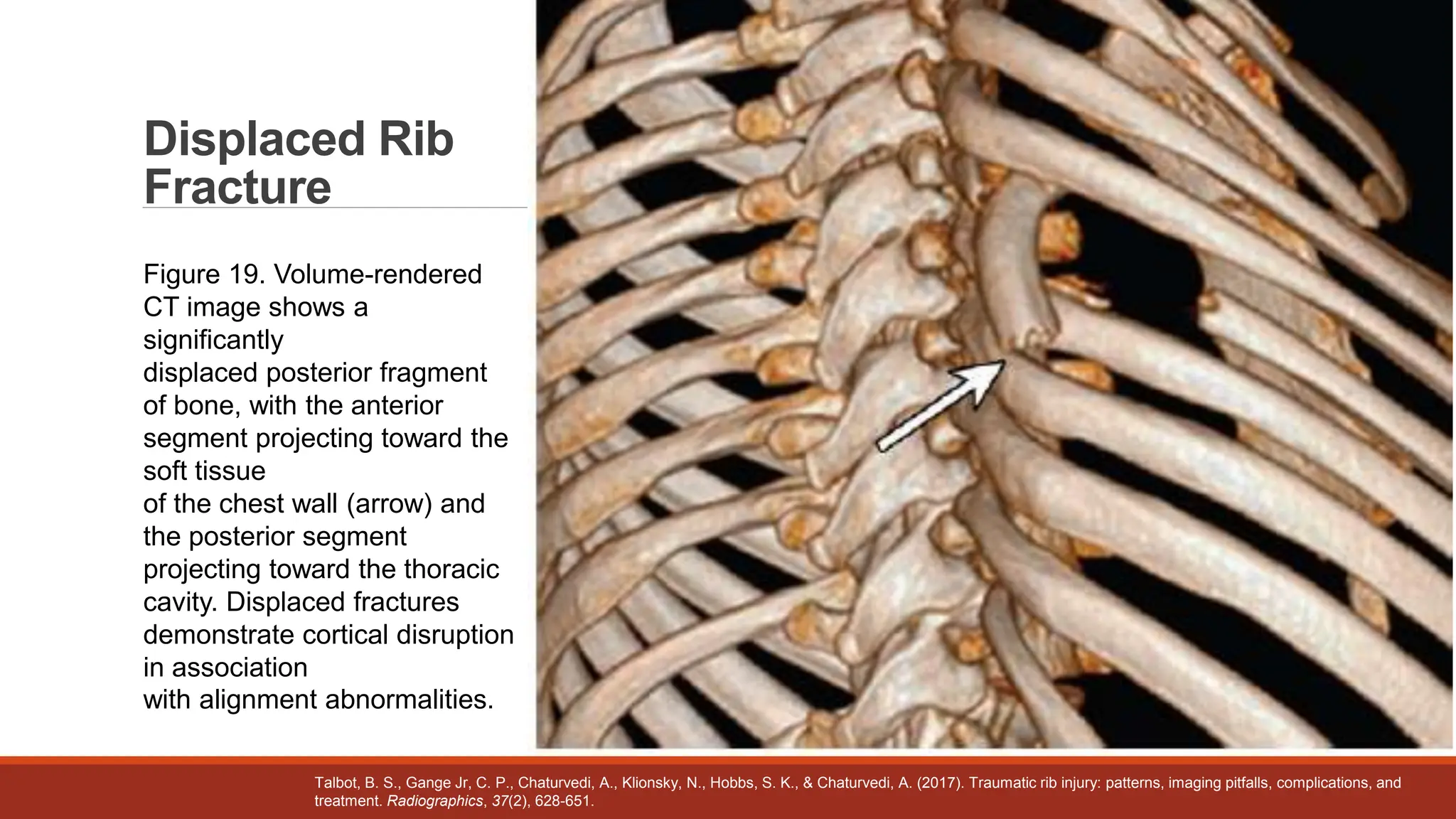 Journal 1 ppt rib injury trauma - Copy.pptx