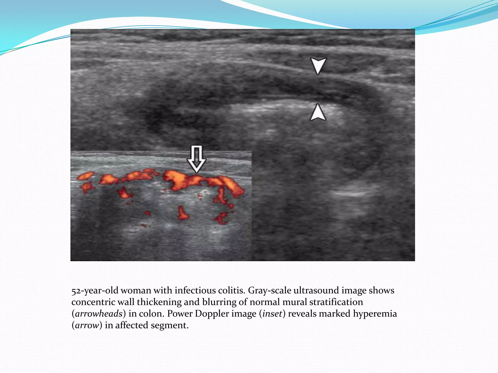 Ultrasound imaging of Bowel pathology | PPTX