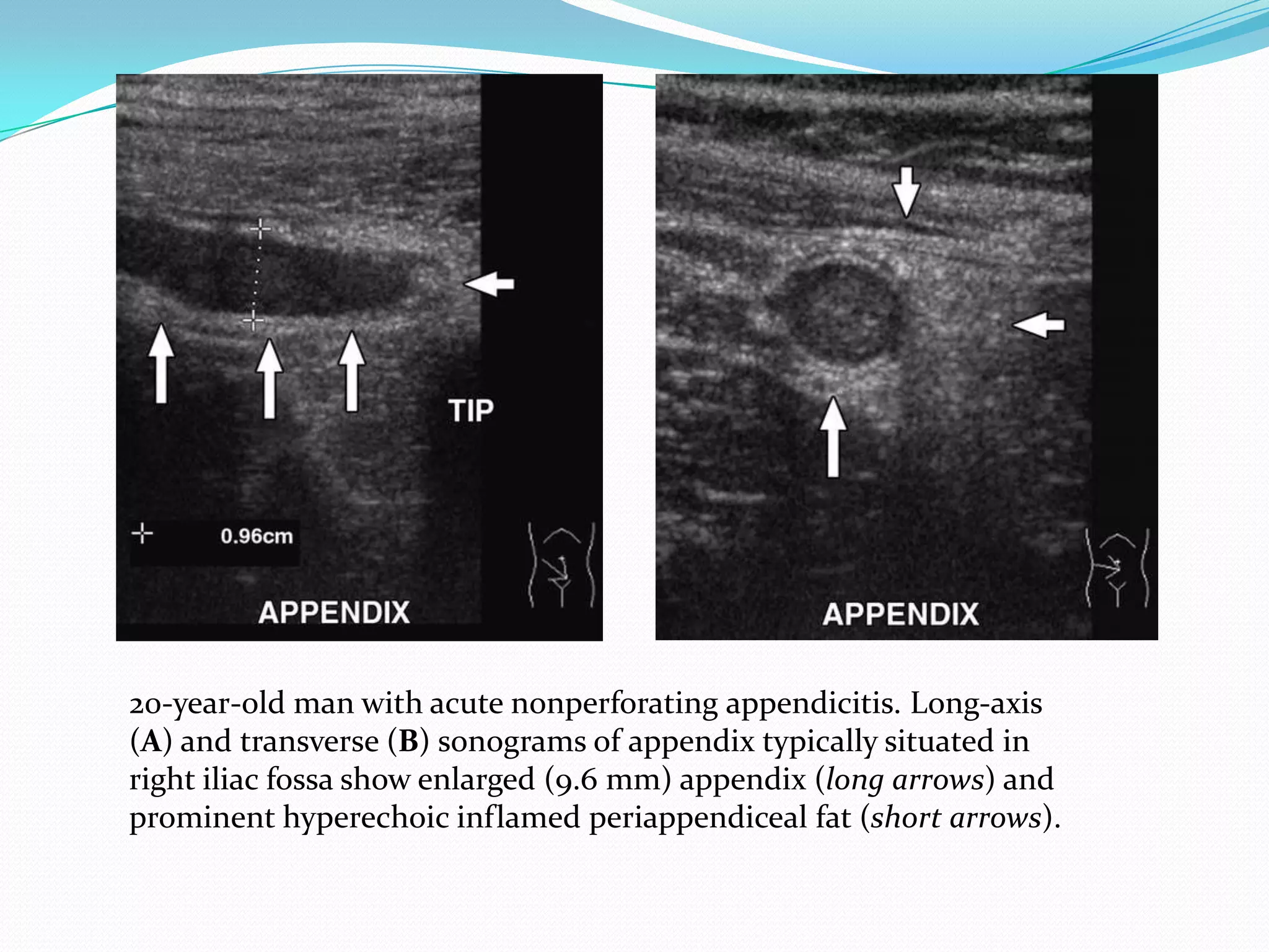 Ultrasound imaging of Bowel pathology | PPTX