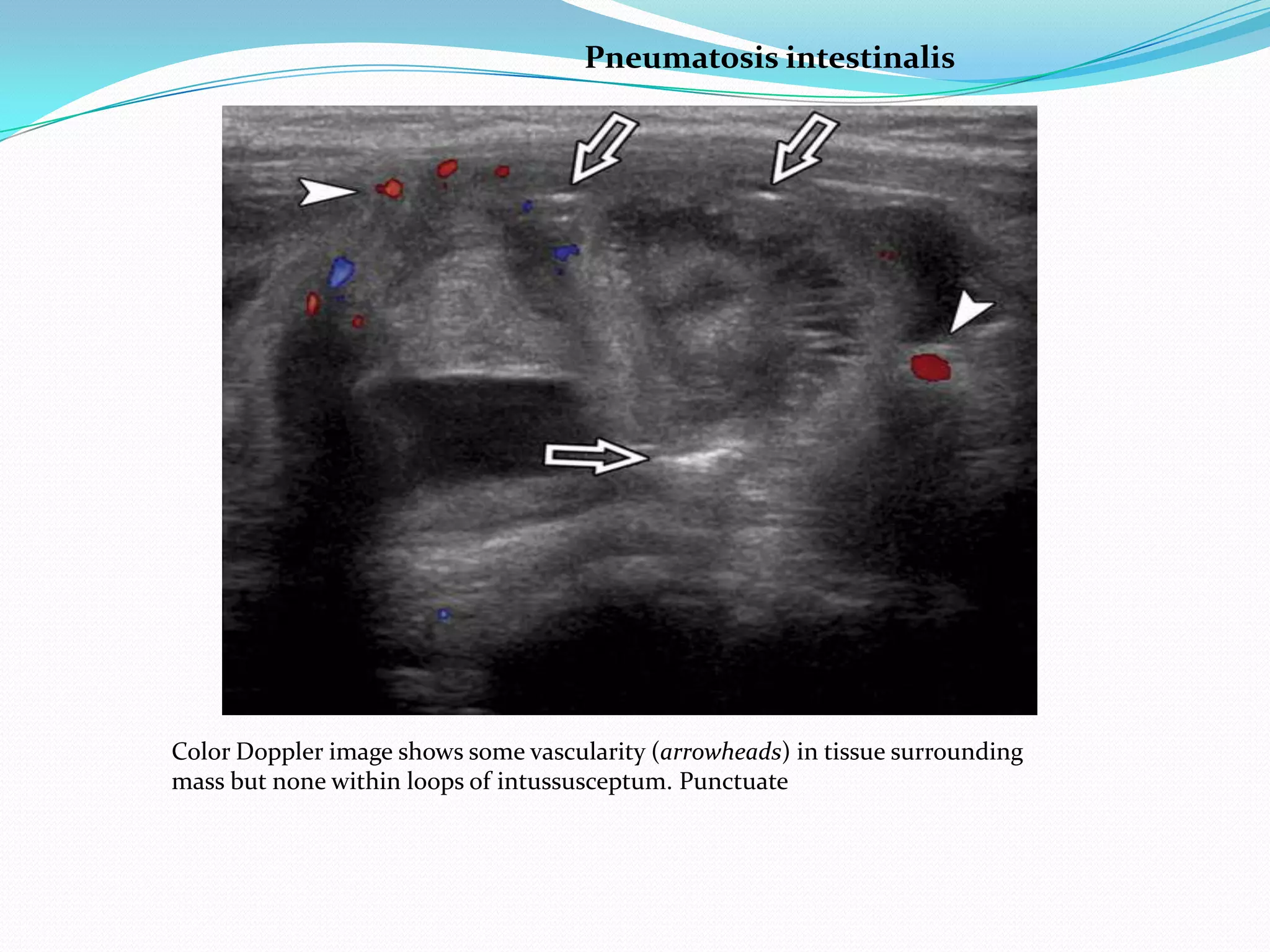 Ultrasound imaging of Bowel pathology | PPTX
