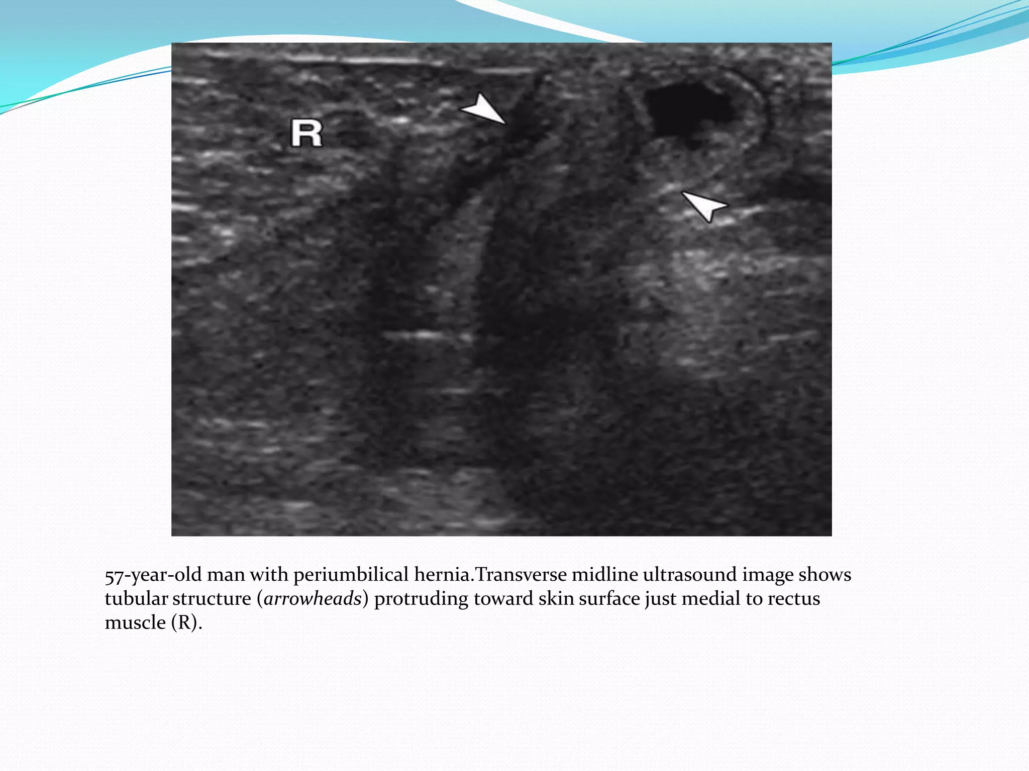 Ultrasound imaging of Bowel pathology | PPTX