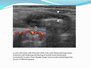 Ultrasound imaging of Bowel pathology | PPTX