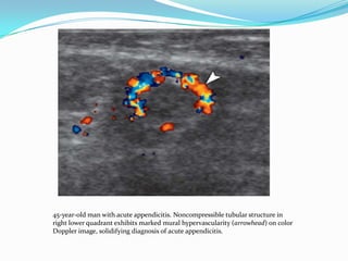 Ultrasound imaging of Bowel pathology | PPTX