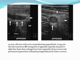 Ultrasound imaging of Bowel pathology | PPTX