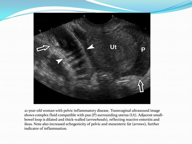 Ultrasound imaging of Bowel pathology | PPTX | Digestive Disorders ...
