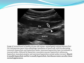 Ultrasound imaging of Bowel pathology | PPTX