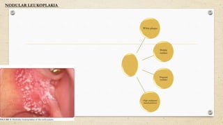 PDT IN OLK !!! - photodynamic therapy in oral leukoplakia | PPTX