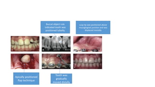 surgical and orthodontic management of impacted canines- jc | PDF