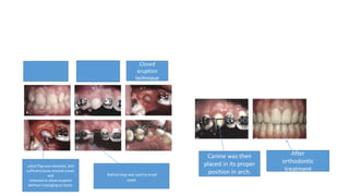 surgical and orthodontic management of impacted canines- jc | PDF
