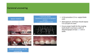 surgical and orthodontic management of impacted canines- jc | PDF
