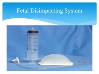 second stage cesarean section : patwardhan | PPTX