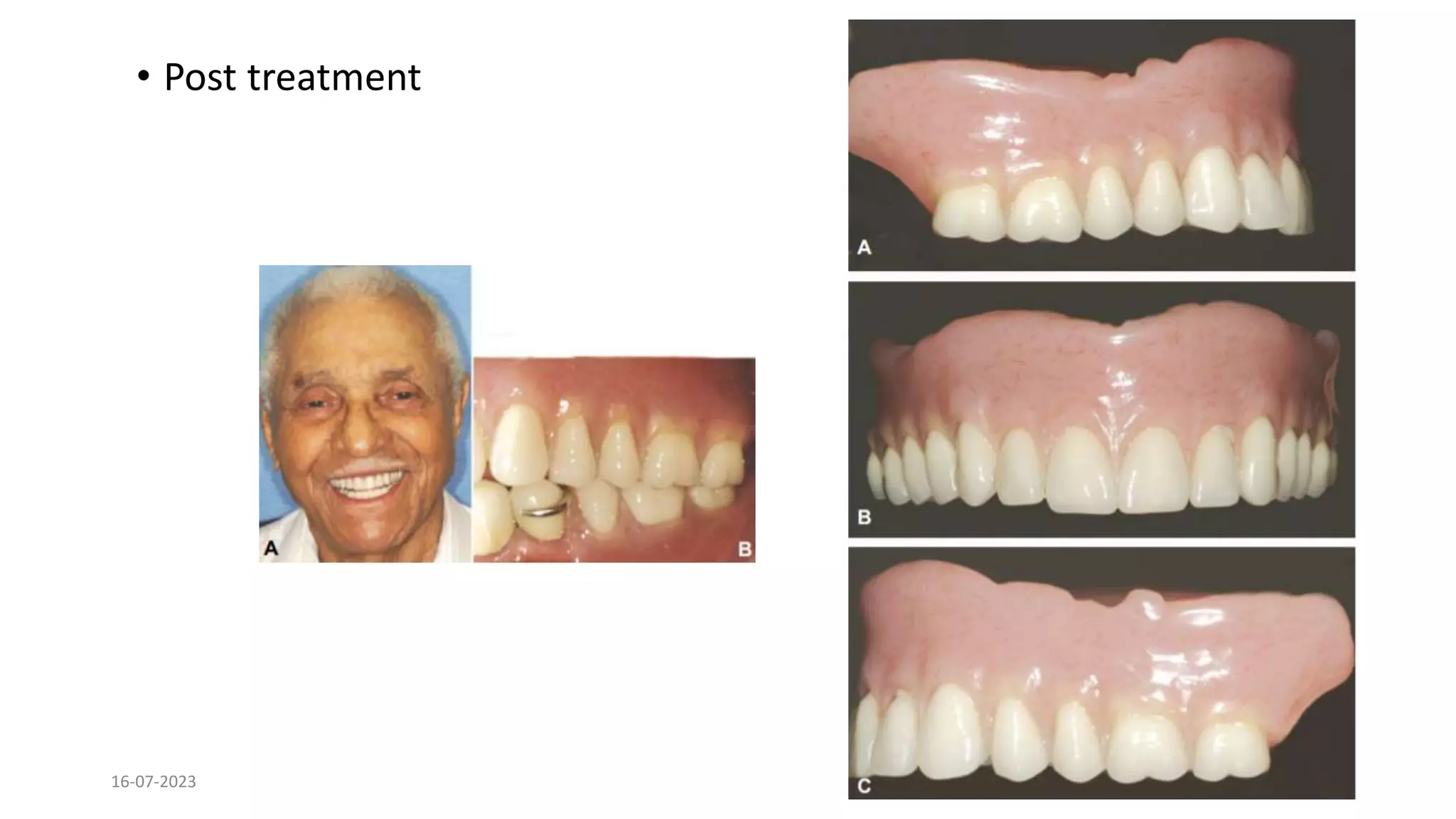 JOURNAL CLUB on retention in complete denture | PPTX