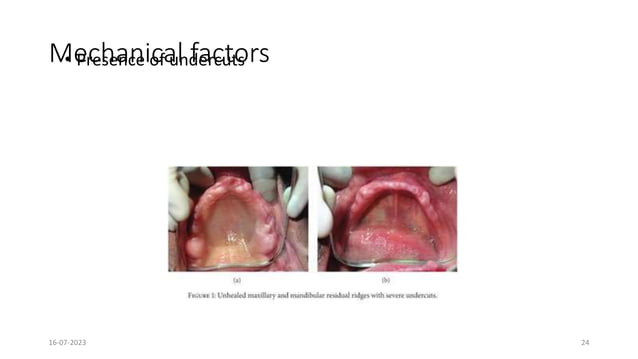JOURNAL CLUB on retention in complete denture | PPTX | Oral care ...