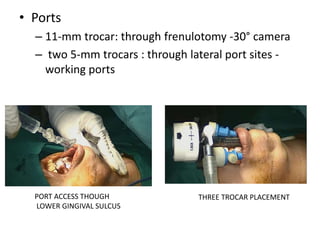 Endoscopic thyroidectomy through Oro- vestibular route | PPTX