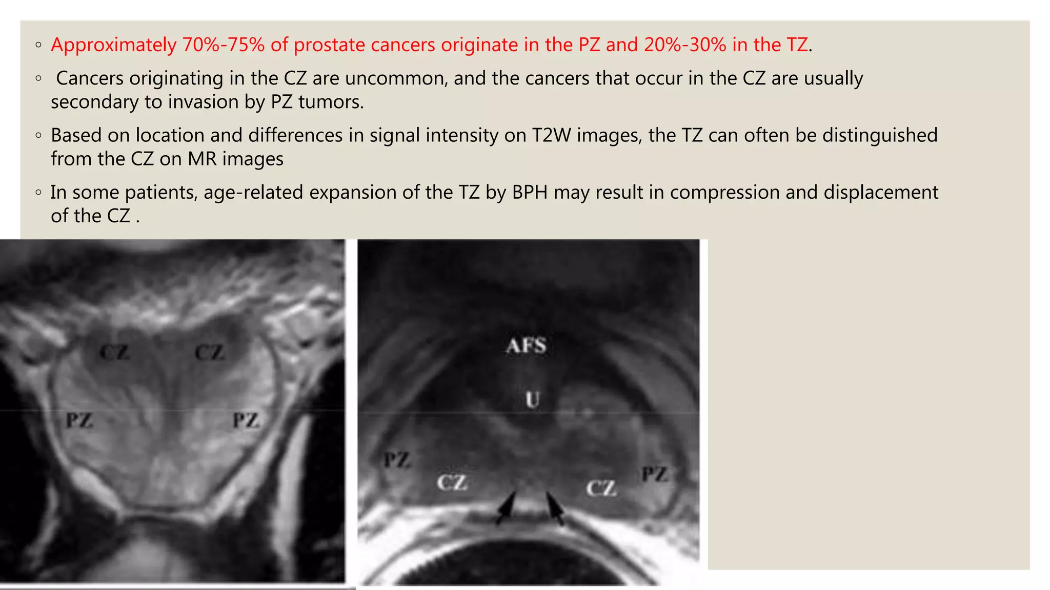 PROSTATE MRI IMAGING - PIRADS V2 2015 | PPTX
