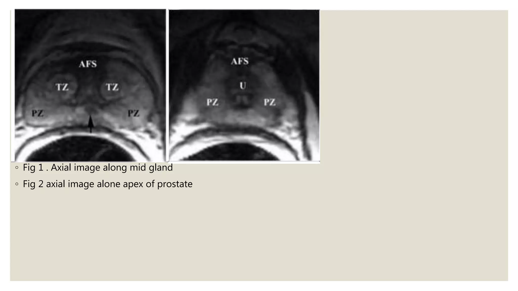 PROSTATE MRI IMAGING - PIRADS V2 2015 | PPTX