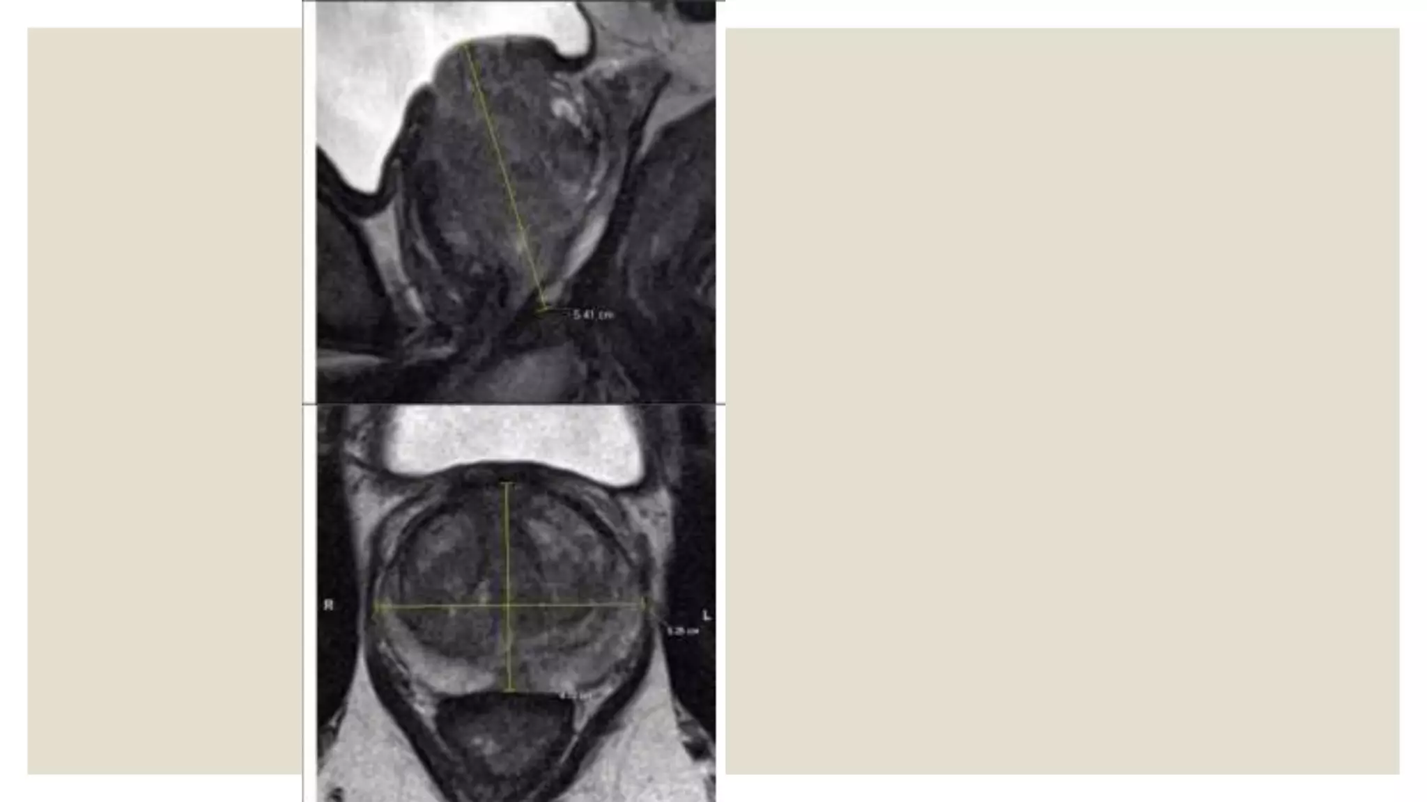 PROSTATE MRI IMAGING - PIRADS V2 2015 | PPTX