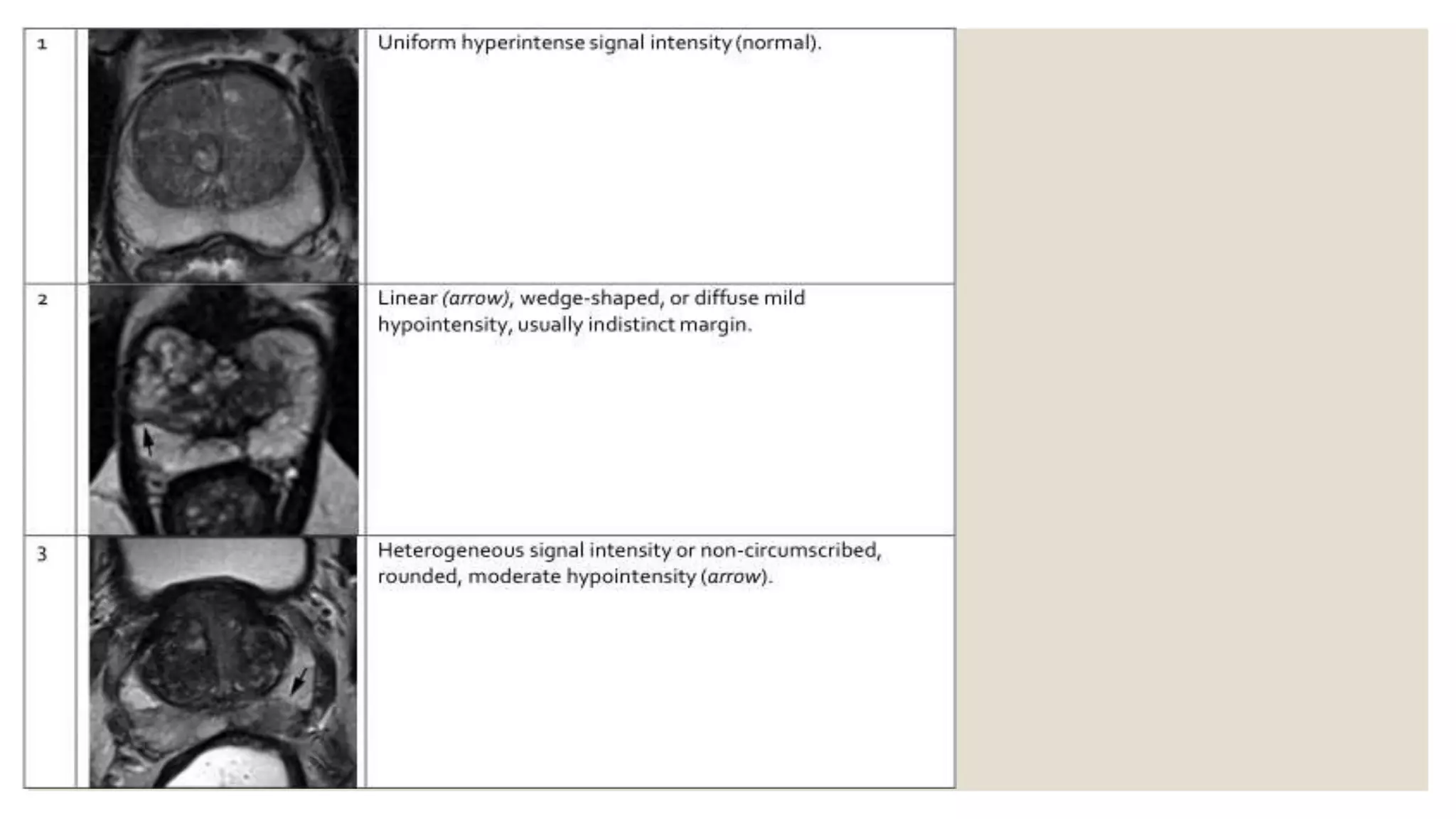 PROSTATE MRI IMAGING - PIRADS V2 2015 | PPTX