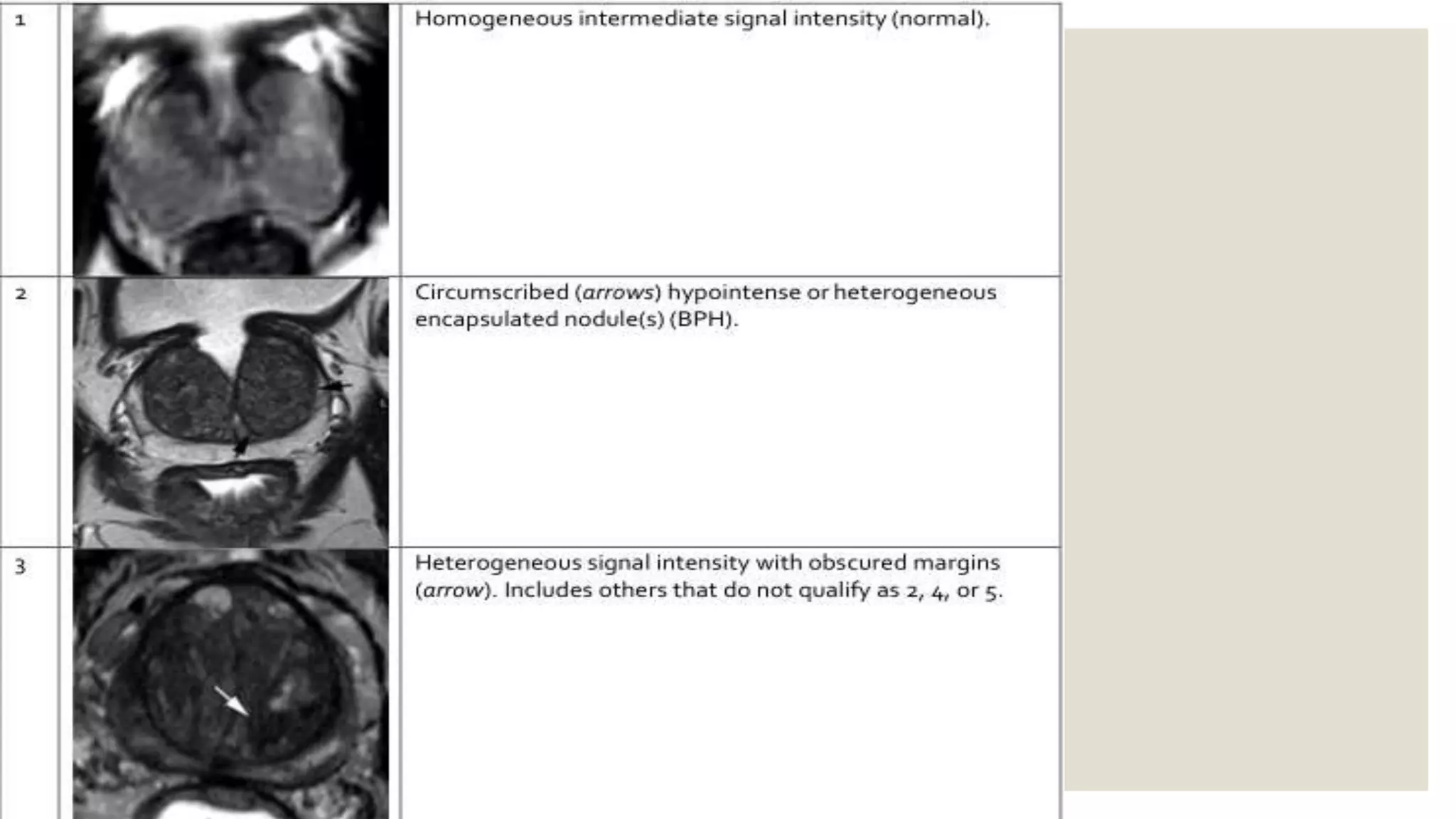 PROSTATE MRI IMAGING - PIRADS V2 2015 | PPTX