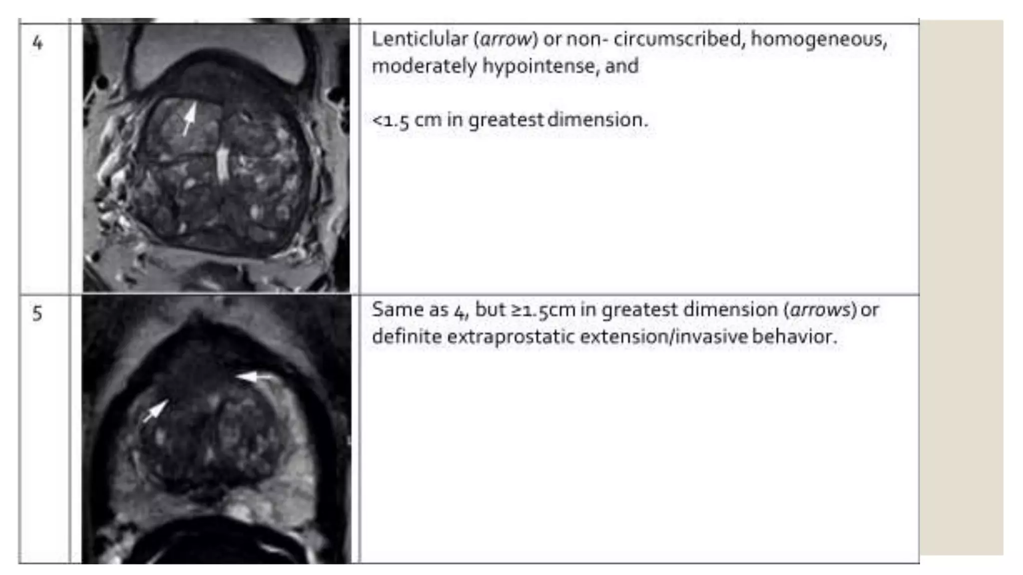 PROSTATE MRI IMAGING - PIRADS V2 2015 | PPTX
