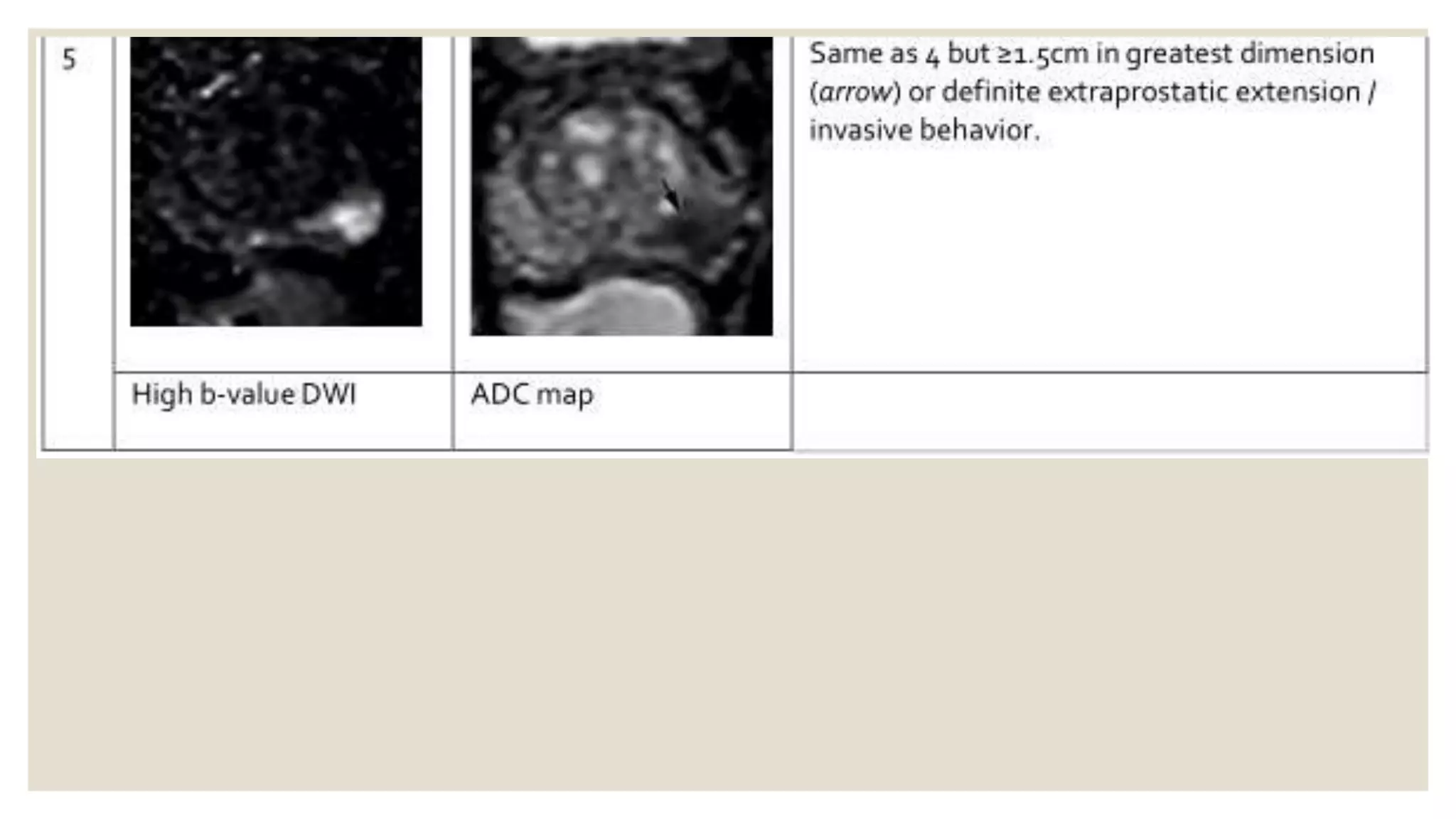 PROSTATE MRI IMAGING - PIRADS V2 2015 | PPTX