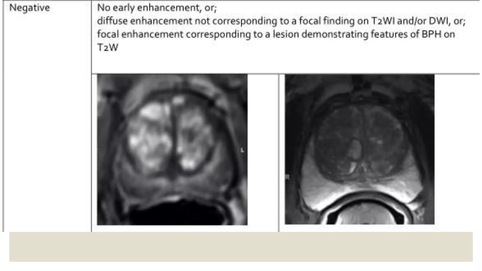 PROSTATE MRI IMAGING - PIRADS V2 2015 | PPTX