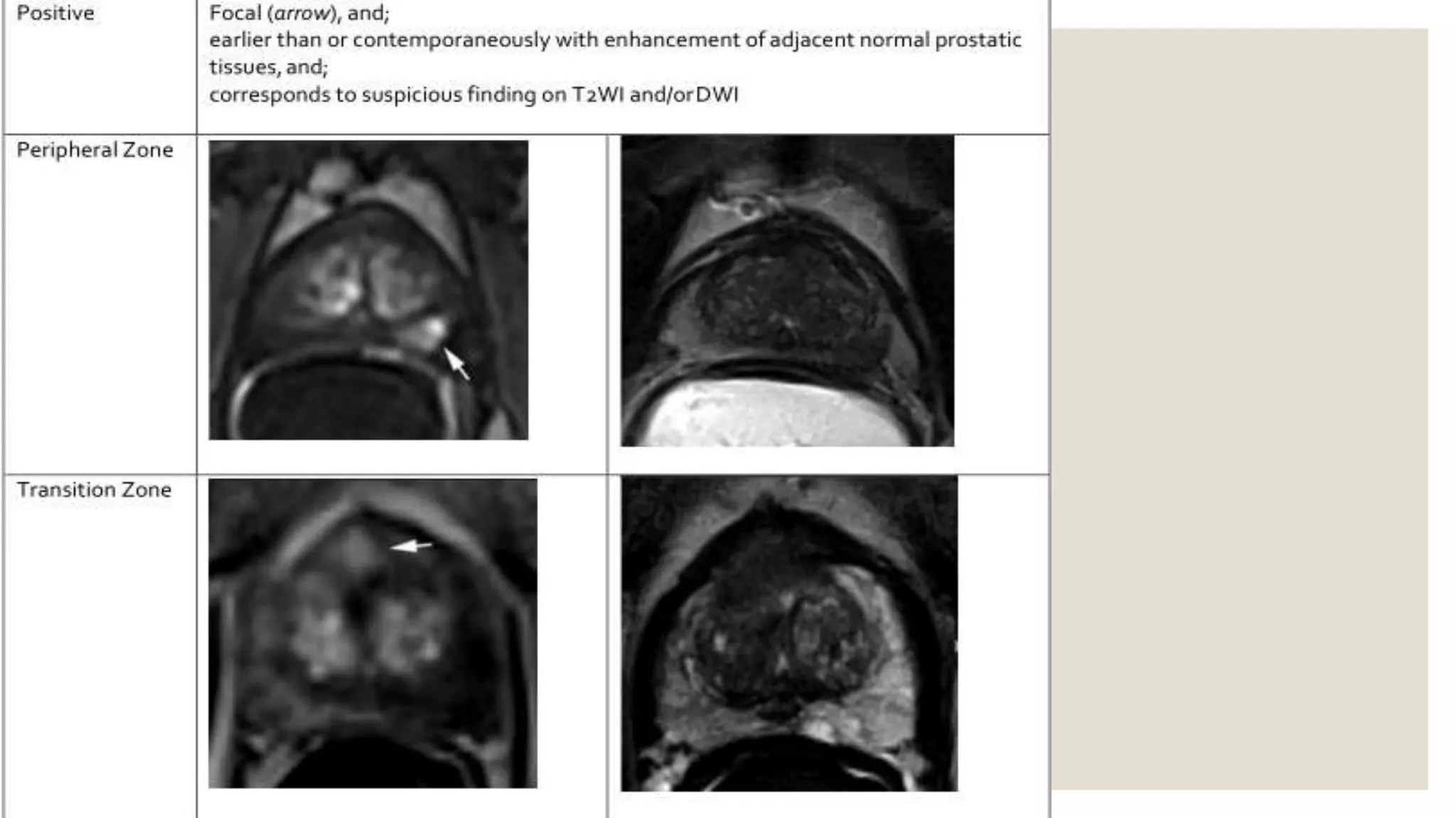 PROSTATE MRI IMAGING - PIRADS V2 2015 | PPTX