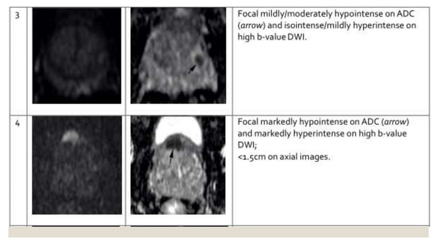 PROSTATE MRI IMAGING - PIRADS V2 2015 | PPTX | Digestive Disorders ...