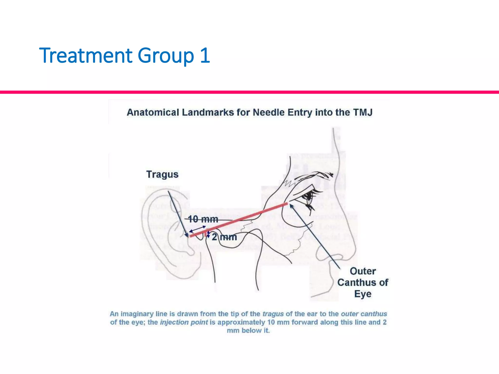 Arthrocentesis of Temporomandibular Joint | PPTX