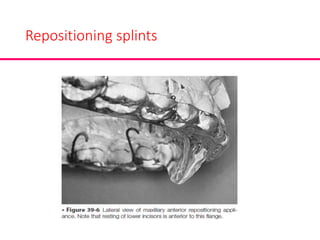 Arthrocentesis of Temporomandibular Joint | PPT