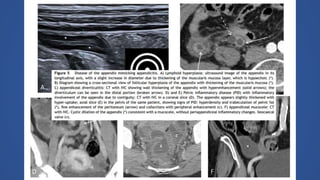 journal club discussing acute appendicitis.pptx | Digestive Disorders ...