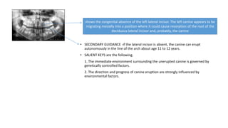 Etiology of maxillary canine impaction | PPT