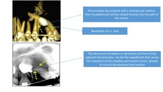 Etiology of maxillary canine impaction | PPT