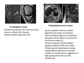 Journal club ACL PCL.pptx