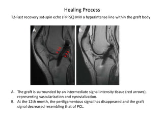 Journal club ACL PCL.pptx