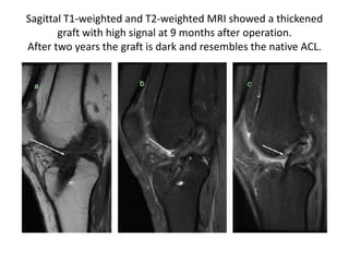 Journal club ACL PCL.pptx