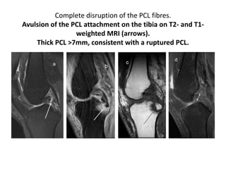 Journal club ACL PCL.pptx