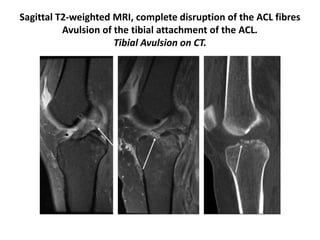 Journal club ACL PCL.pptx