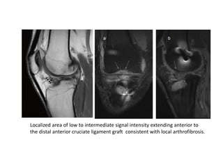 Journal club ACL PCL.pptx