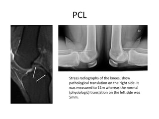 Journal club ACL PCL.pptx