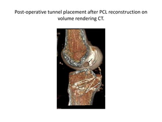Journal club ACL PCL.pptx