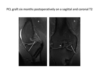 Journal club ACL PCL.pptx