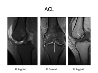 Journal club ACL PCL.pptx