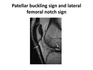 Journal club ACL PCL.pptx