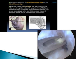 acl arthroscopic reconstruction single bundle vs double bundle | PPTX