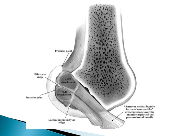 acl arthroscopic reconstruction single bundle vs double bundle | PPT