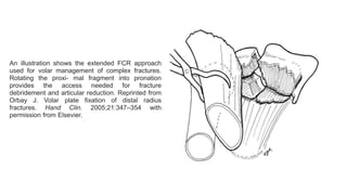 Journal club by Dr. Amit Motwani distal end radius | PPTX