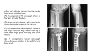 Journal club by Dr. Amit Motwani distal end radius | PPTX