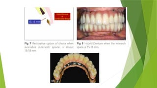Journal club interarch distance attachments Prosthodontics | PPT